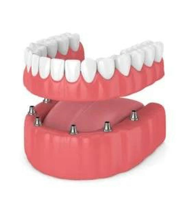 7 types of dentures - which one is right for you？